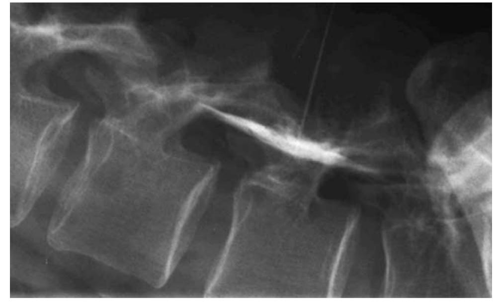 Epidural contrast injection. patient is lying in prone