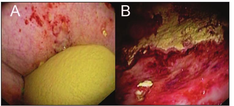 Figure 1 - from Sabulous cystitis in the horse: 13 cases