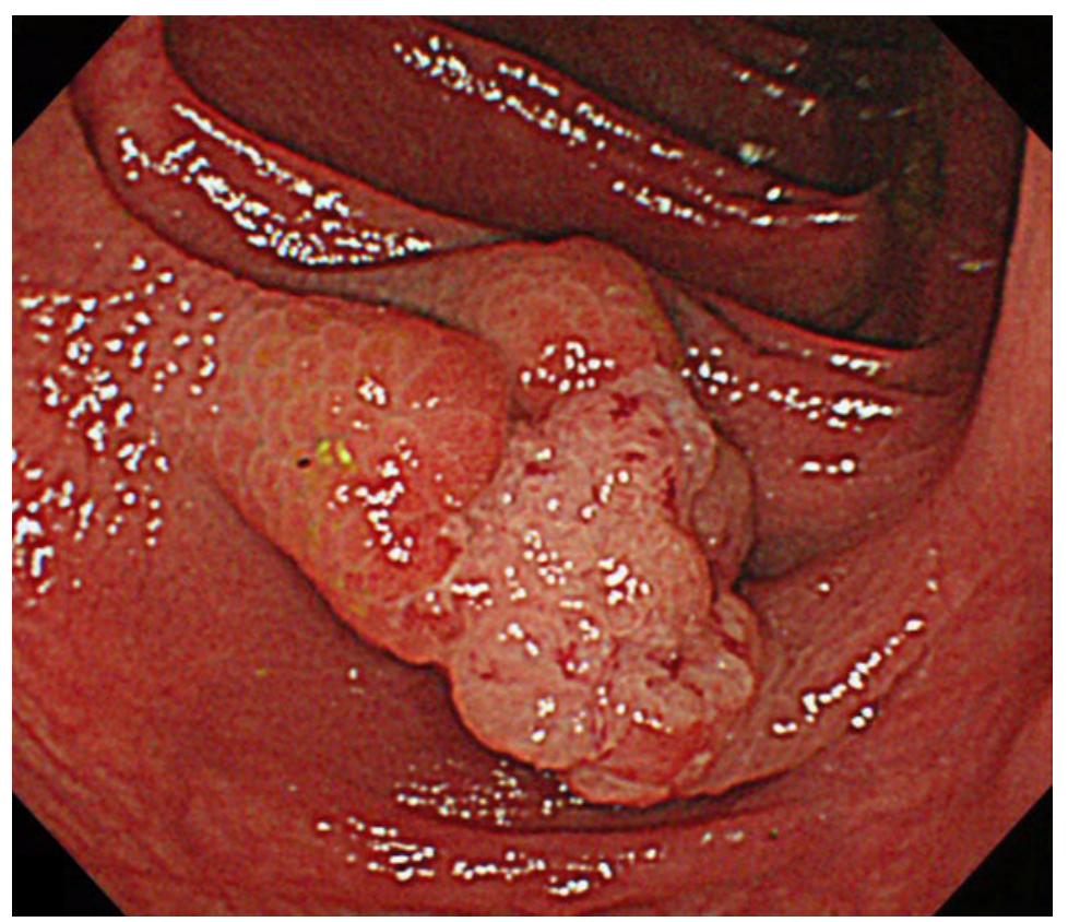 Endoscopic image showing a flat elevated polyp of 25 mm in
