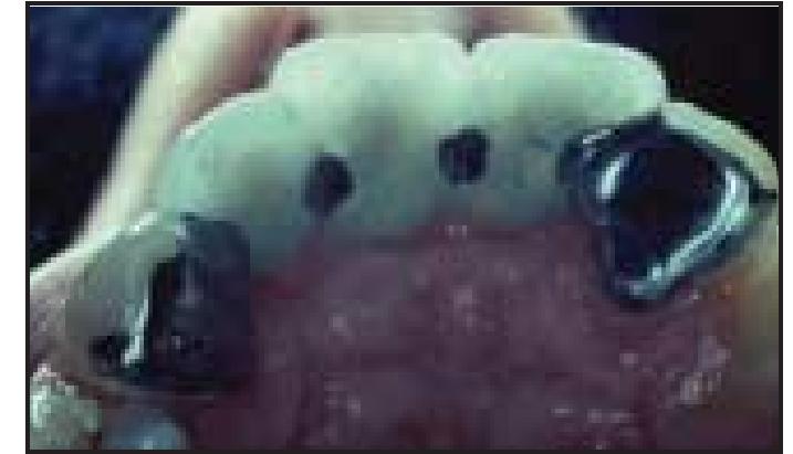 A modern framework for an anterior adhesive bridge. figure