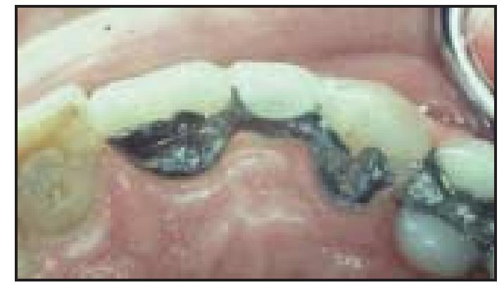 Figure 4 - Clinical Considerations for Adhesive Bridgework