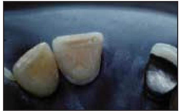 The maxillary central incisor has been prepared to receive