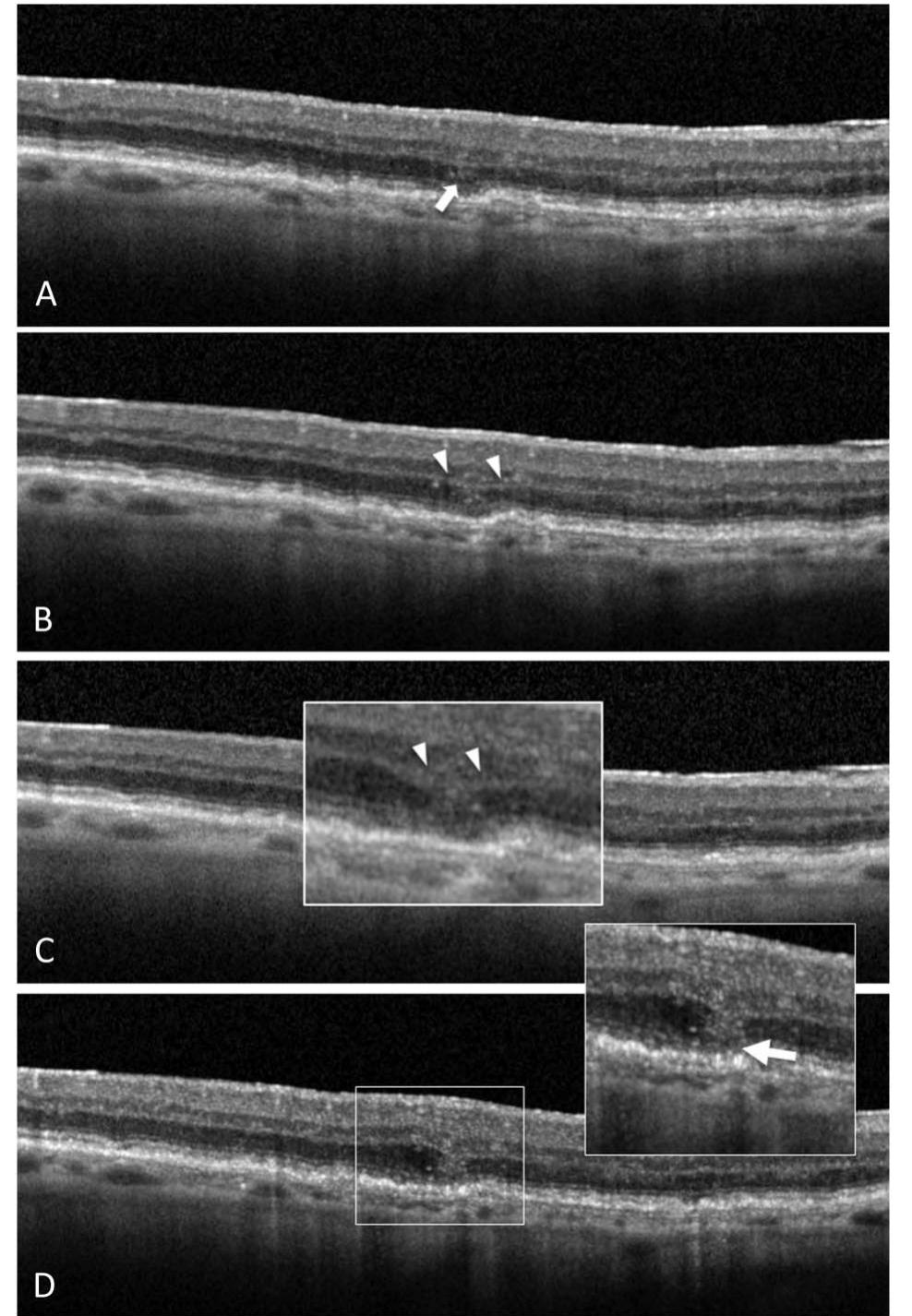 Progression of a stage | type 3 lesion into an early stage 2