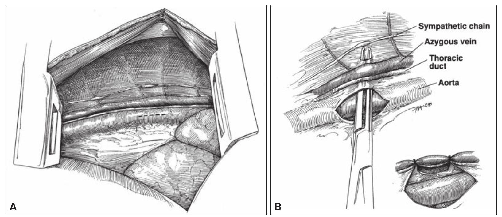 Schematic diagram describing en bloc thoracic duct ligation.
