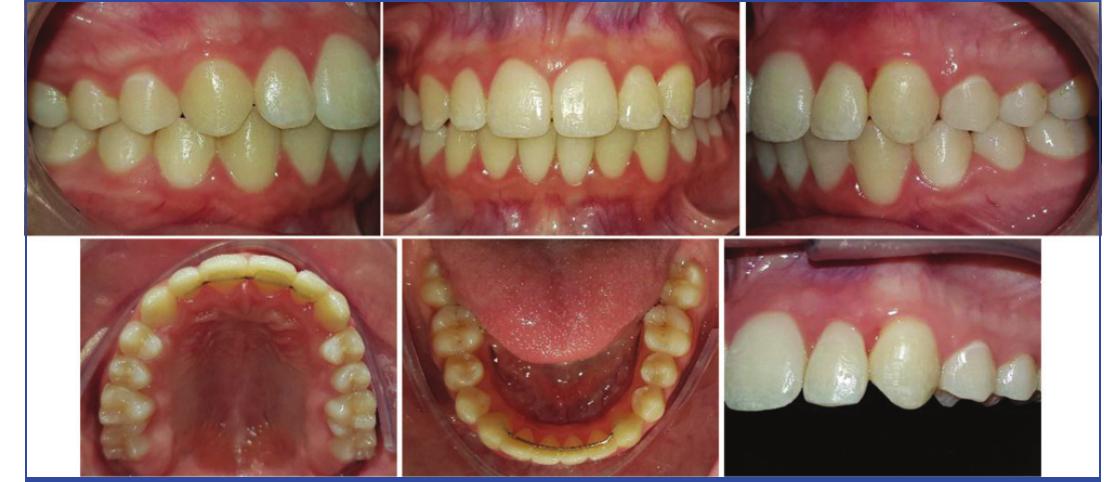 [table/fig-10]: one year follow-up intraoral photographs
