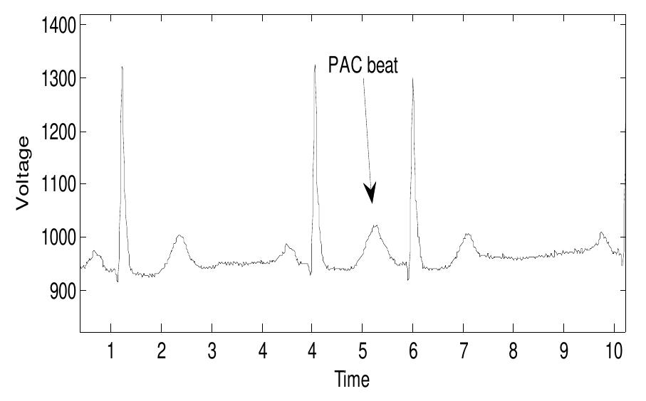 Premature atrial contraction beat premature atrial