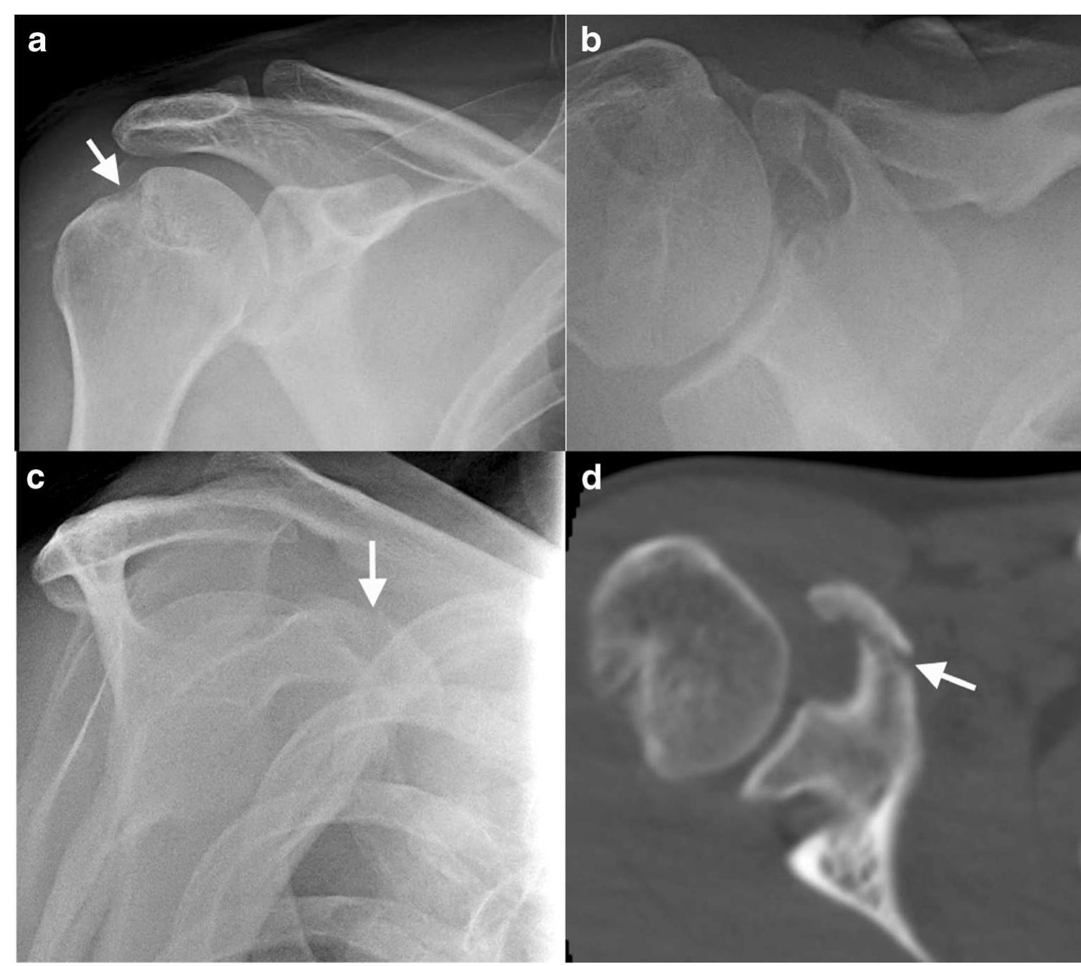 Figure 13 - Coracoid process fractures: anatomy, injury