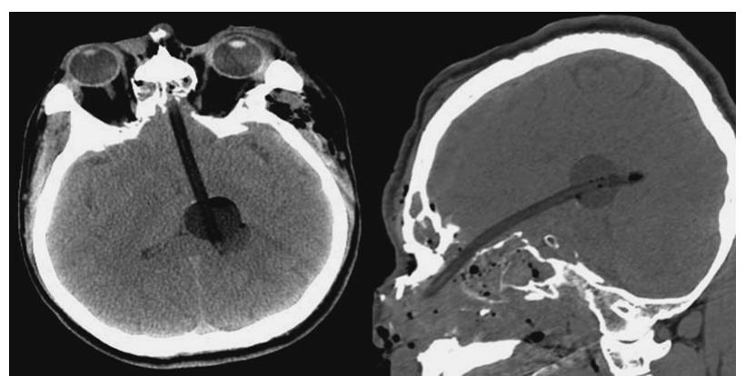 Axial (right) and sagittal (left) brain ct scans revealing a