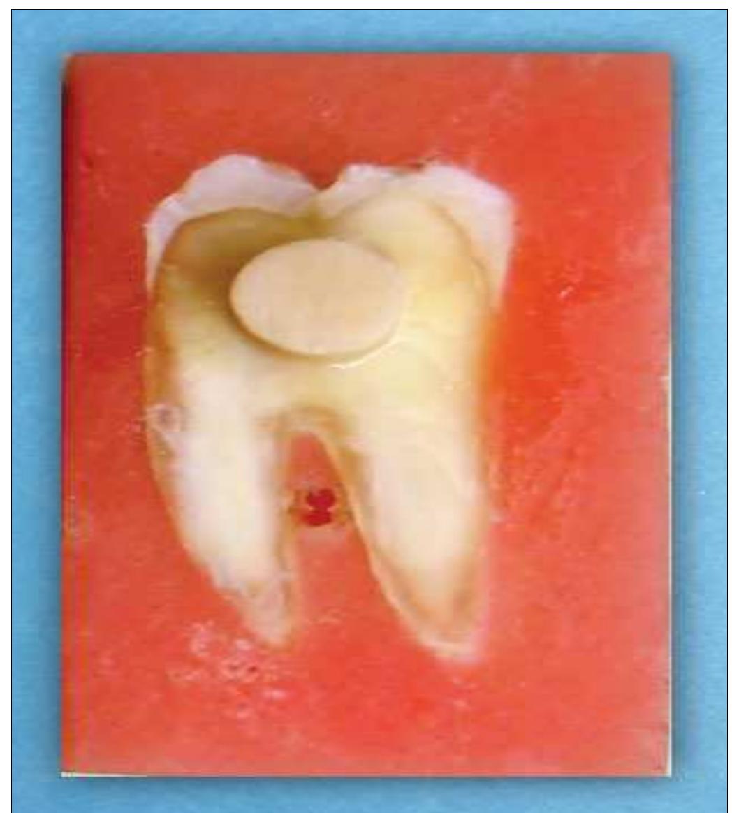 Cementation of zirconia to tooth surface. figure 2. prepared