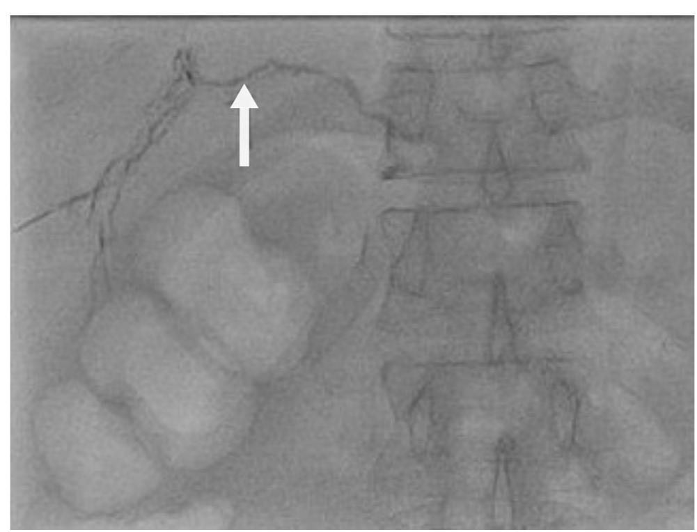 White arrow shows the incidental cannulation and opacifica-
