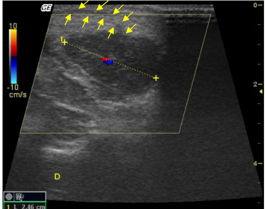 Transversal sonographic image showing the dilated right