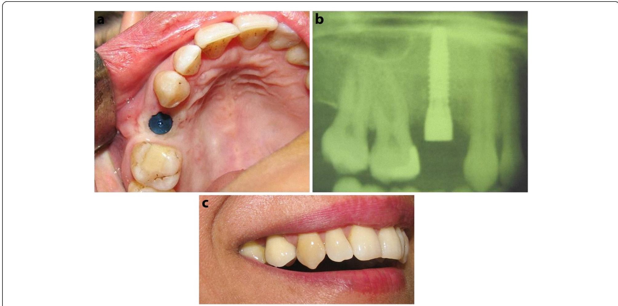 A) one stage implant placement without flap elevation. b)