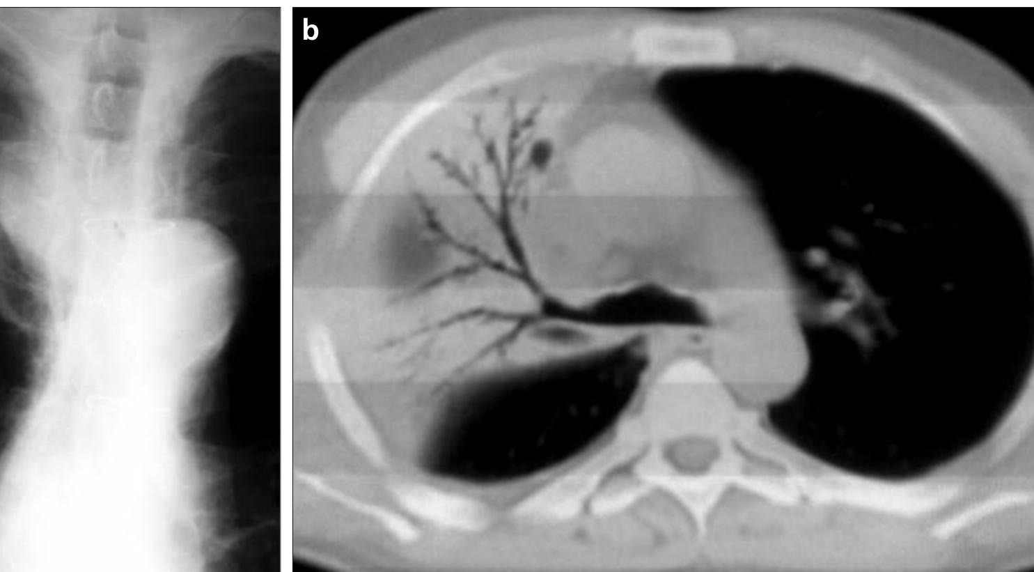 Re 1. a-c. air bronchogram sign. a. chest x-ray of a patient