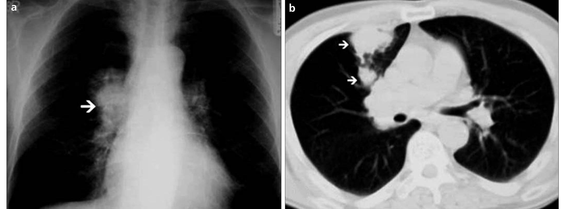 A, b. hilum overlay sign. a. chest x-ray of a patient with