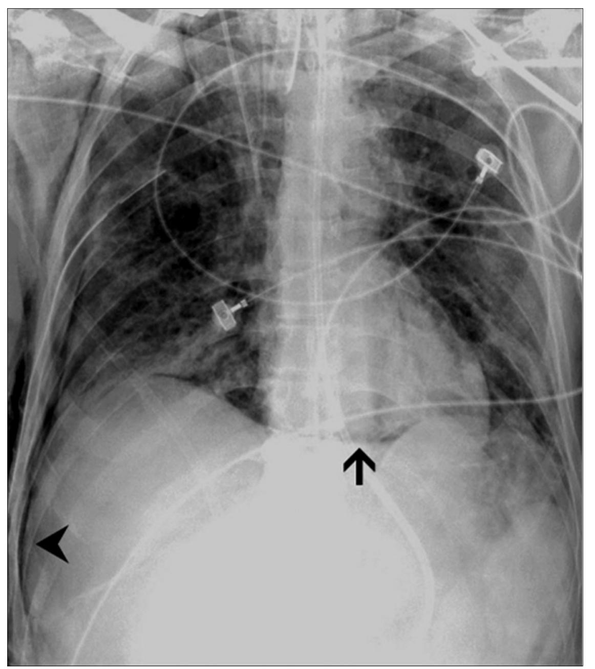 Deep sulcus sign and continuous diaphragm sign. chest x-ray
