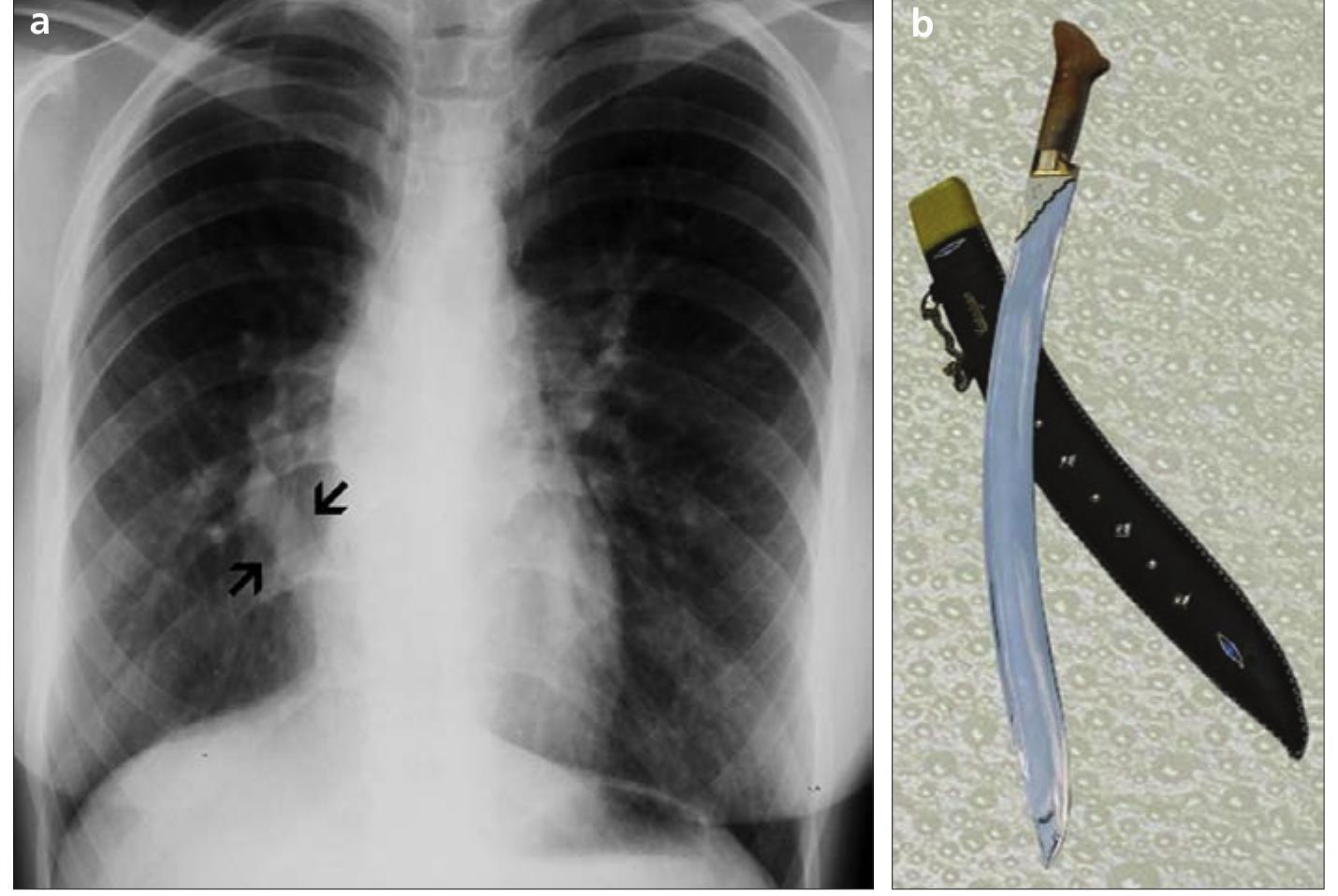 A, b. scimitar sign. a. frontal radiograph of a patient with