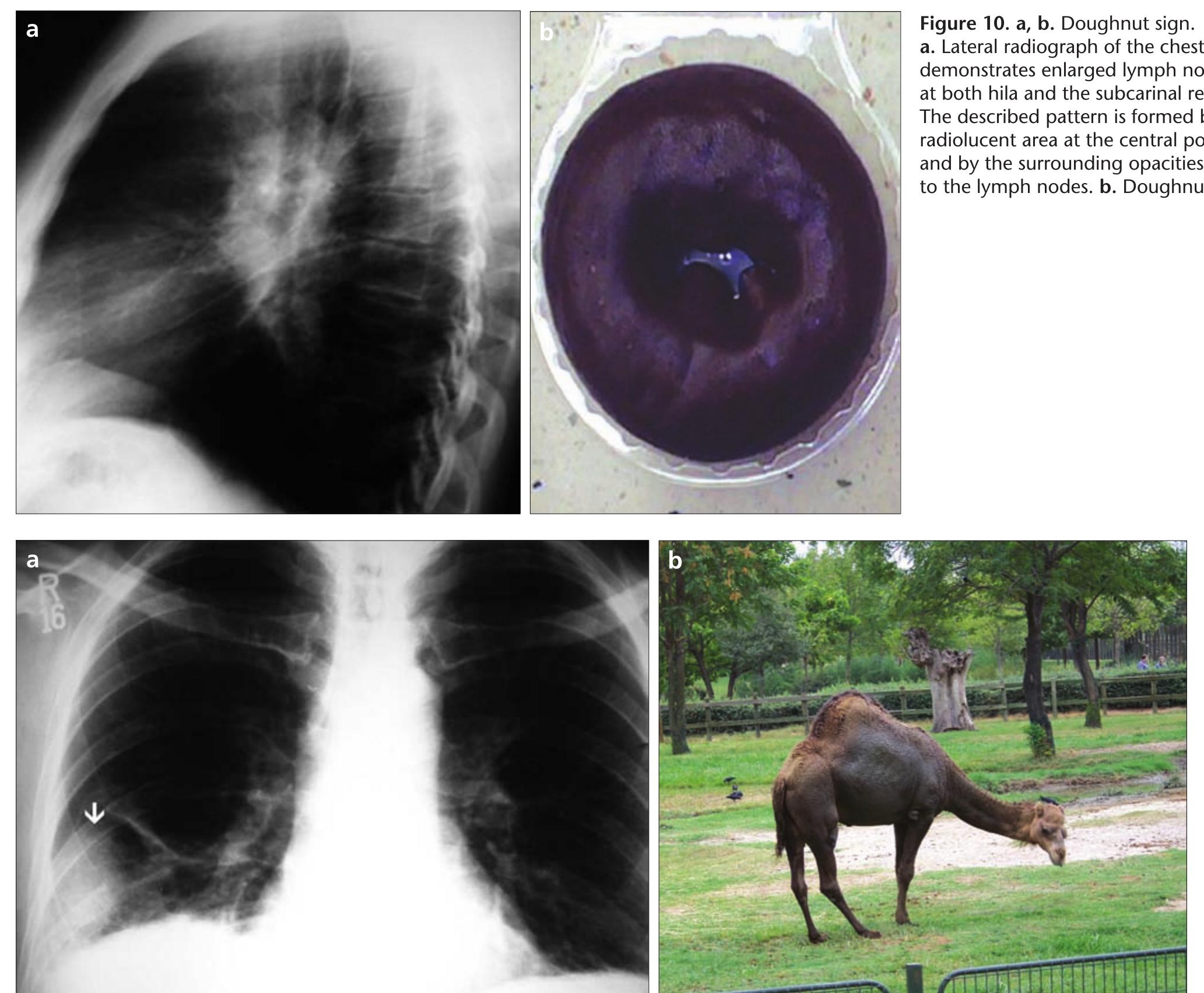 A, b. hampton hump sign. a. chest x-ray of a patient with
