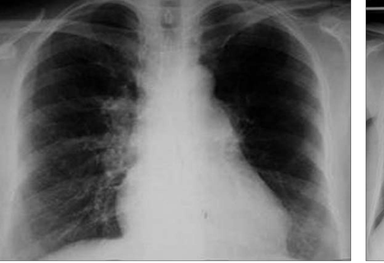 Westermark sign. frontal radiograph of a patient with