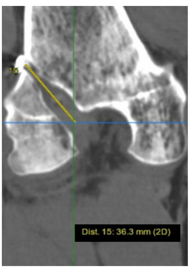 Femoral tunnel length measurement: post-operative two-
