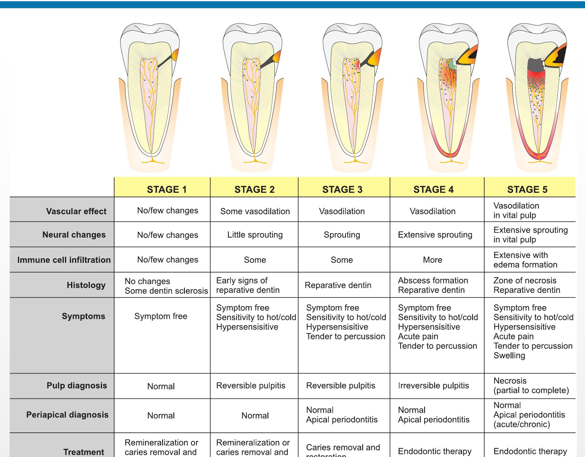 Schematic illustration of the 5 stages of caries progression