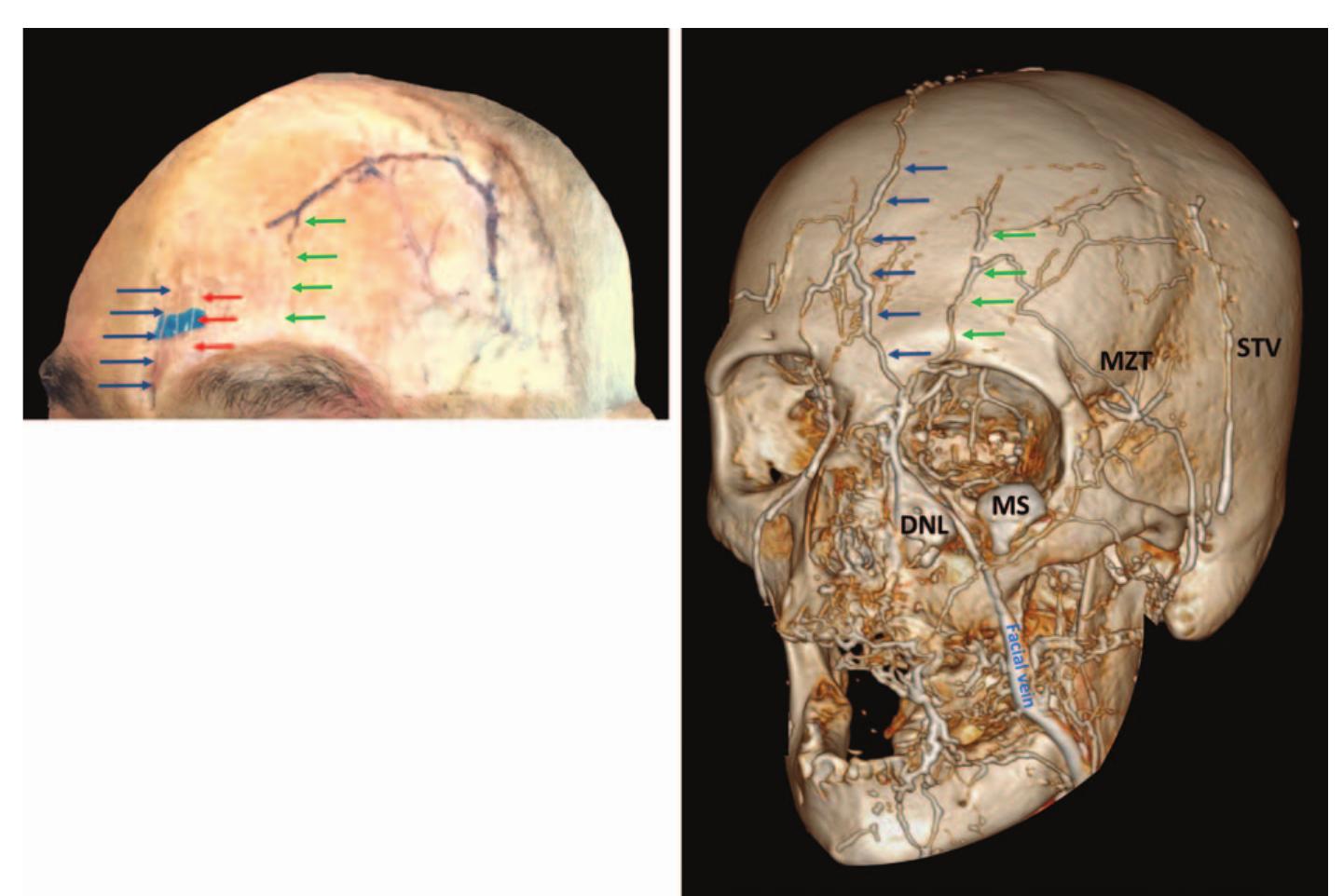 Comparison between cadaveric dissection (/eft) and