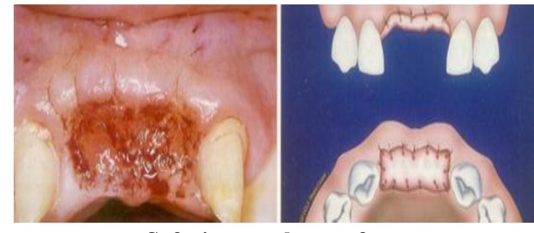 Figure 3 - Alveolar Ridge Deformities and Corrections - A