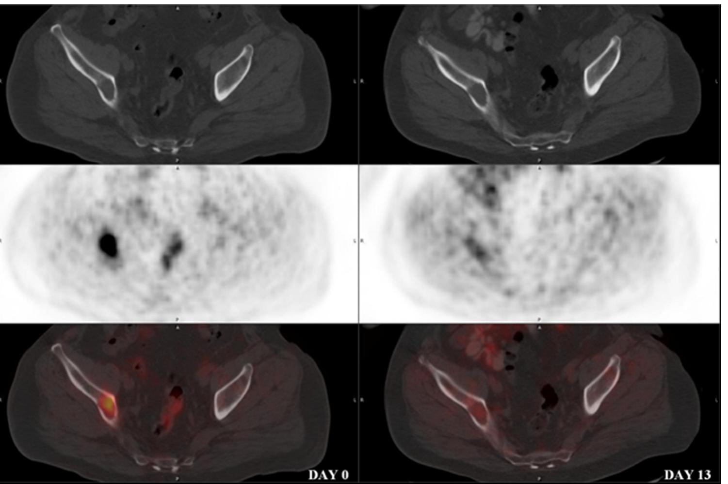 A 78-year-old male with multiple myeloma. positron emission
