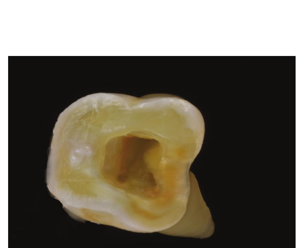 - pulpotomy and access cavity for primary molar.
