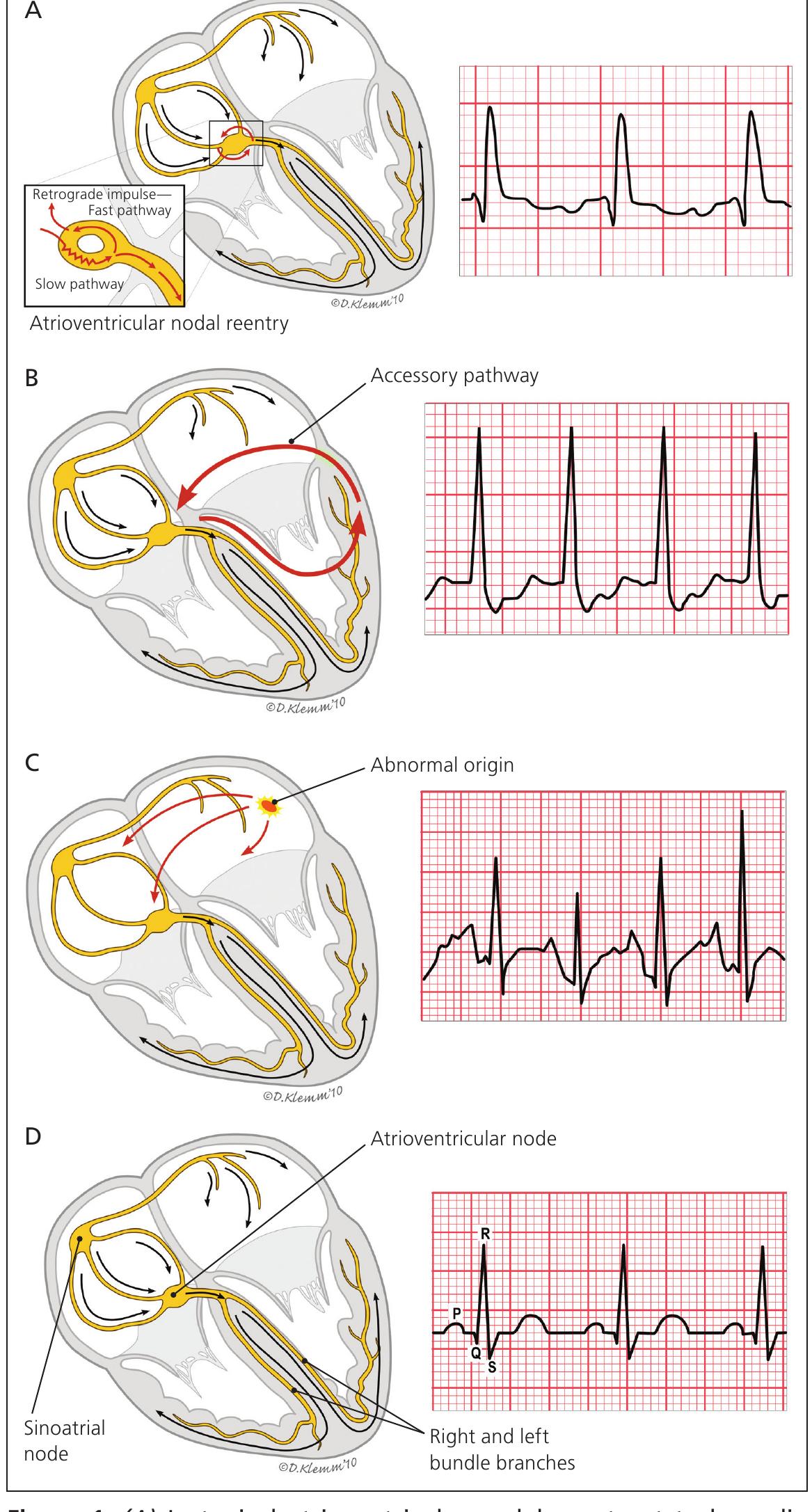 (a) in typical atrioventricular nodal reentrant tachycardia