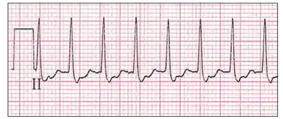 Electrocardiogram of a narrow complex tachy- cardia with