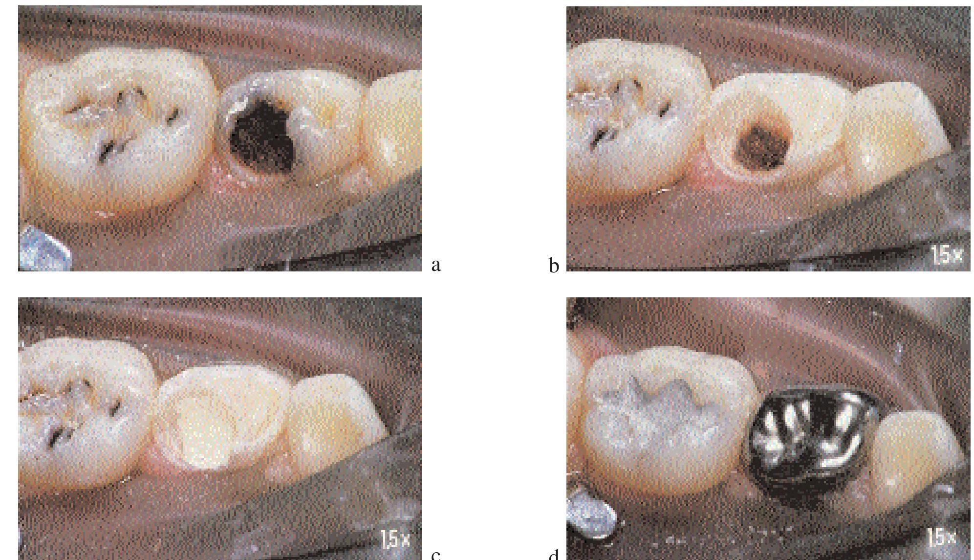 Fic. 1 - mandibular primary molar with extensive caries to