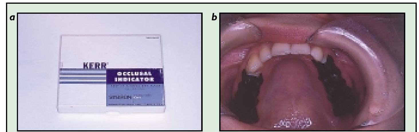 (a, b). occlusal indicator wax. note the perforations on the