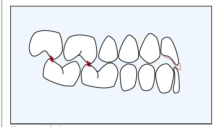 Posterior contacts on protrusion. duml applies. distal