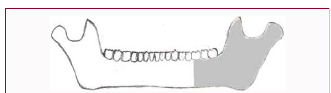 Parasymphyseal unilateral free end mandibulectomy at (right