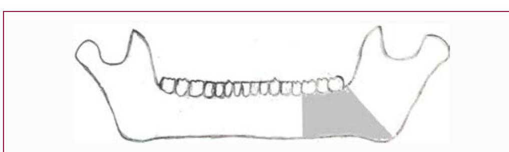 Figure 12 - Classification of Mandibulectomy/Mandibular