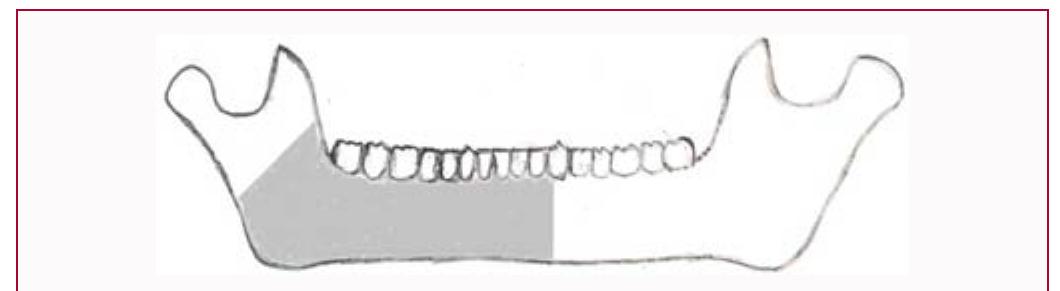 Bilateral ramus-parasymphyseal mandibulectomy at (right or