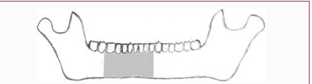 Figure 25 - Classification of Mandibulectomy/Mandibular