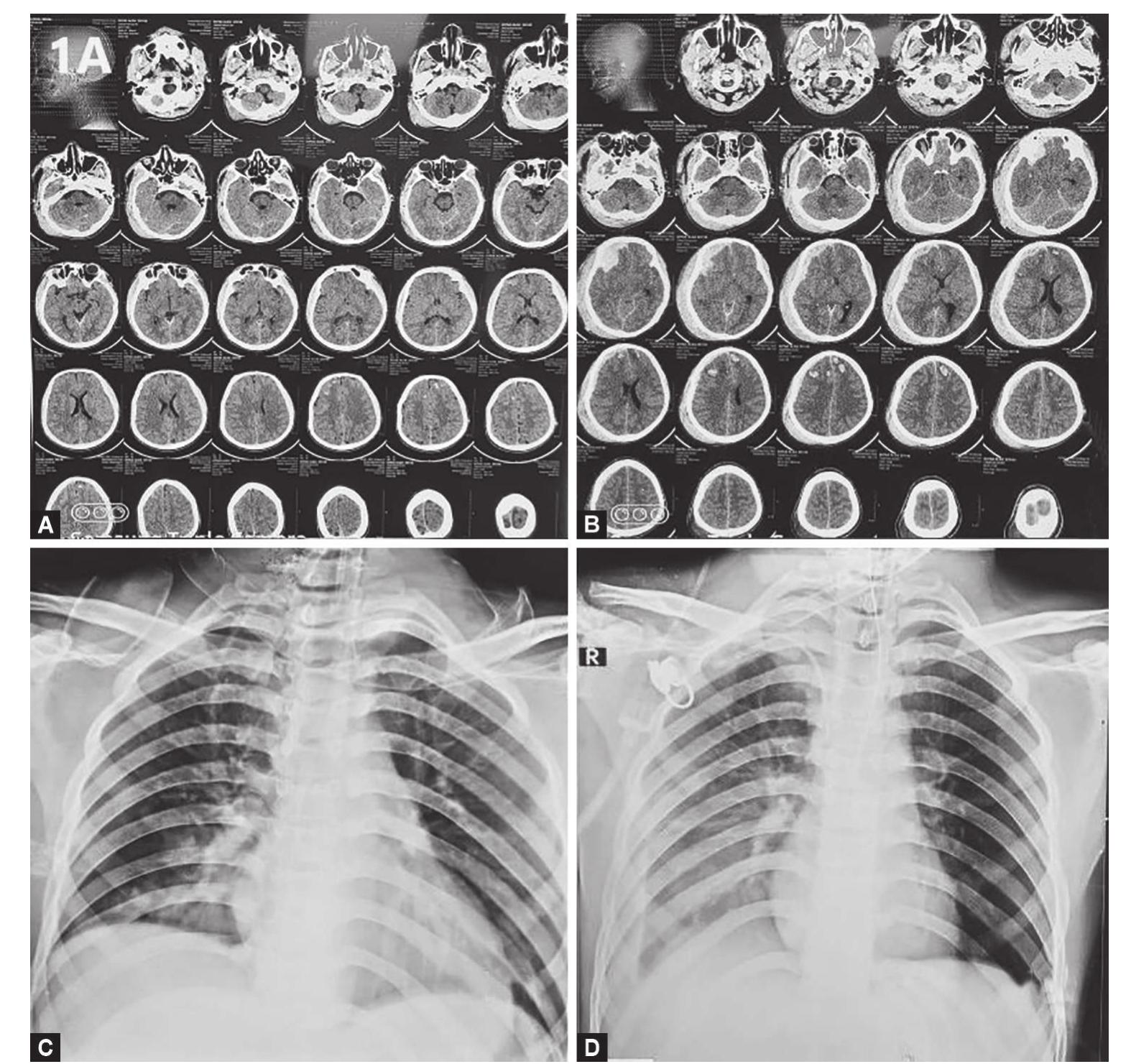 S 1a to d: (a,b) preoperative ct scans; (c) chest radiograph