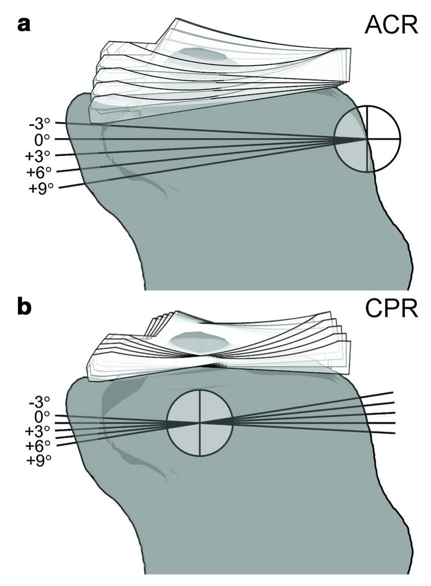 Schematic representation of a anterior tibial cortex