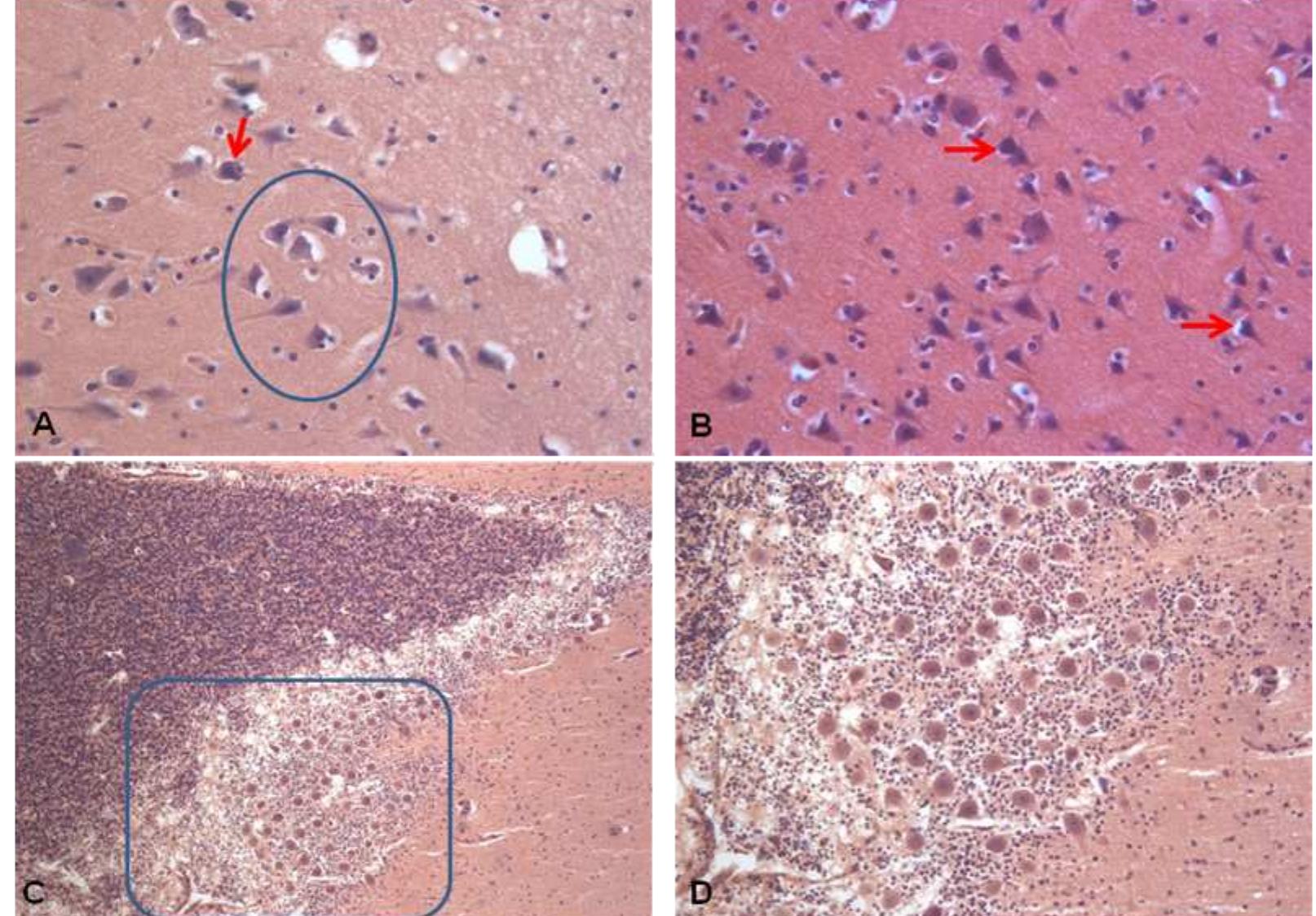Anp 303 A And B Cortex Dysmorphic And Nodular Neurons