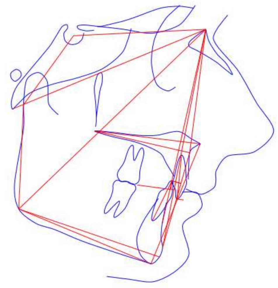 Pre-treatment cephalometric tracing. figure 10.