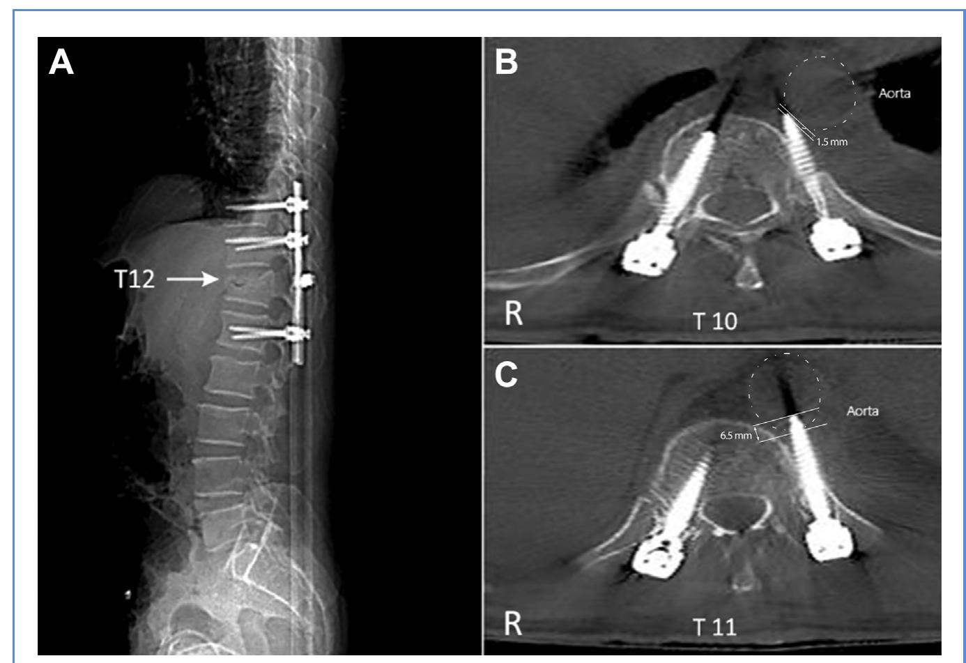 Case 1. (a) thoracolumbar computed tomography, sagittal view