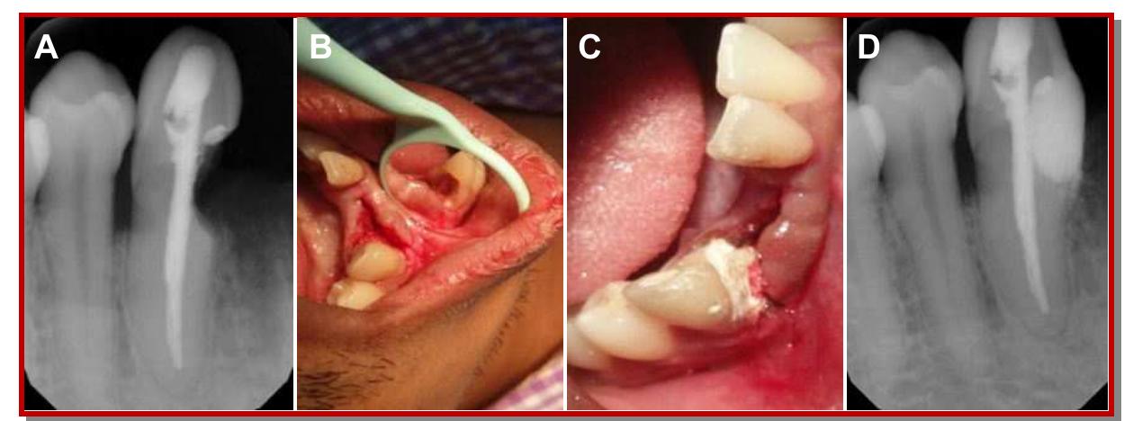 Pre-operative radiograph showing external cervical