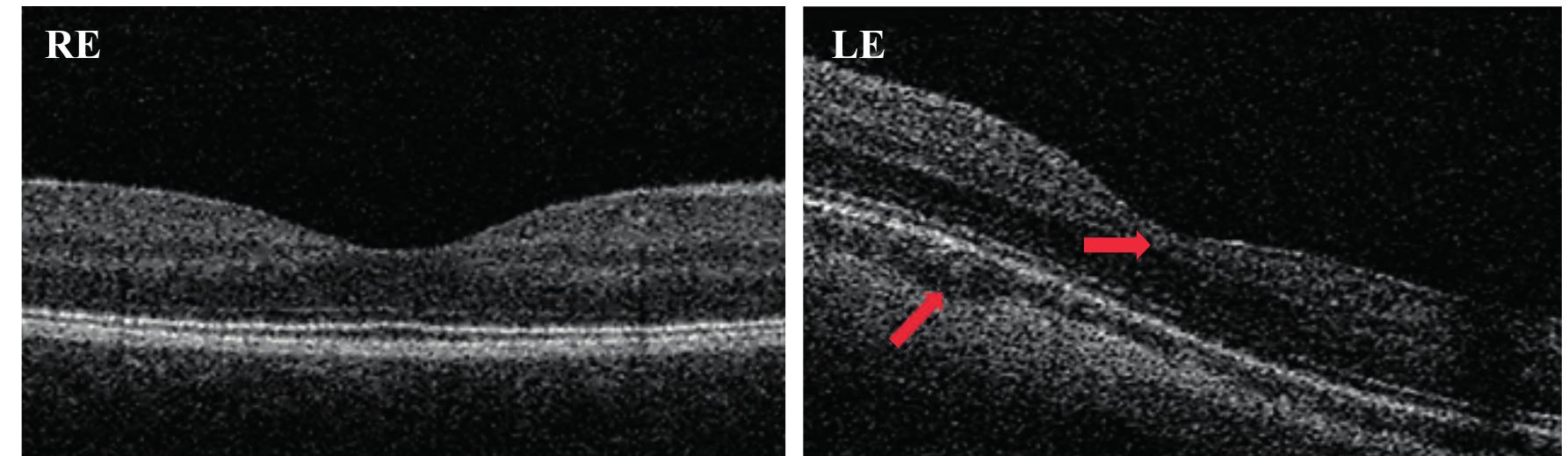 Horizontal scans of the fovea of both eyes. the tomography
