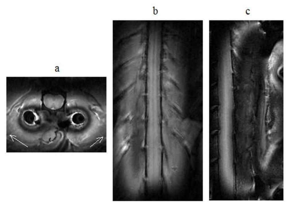 In vivo high resolution spin-echo images of spinal cord in