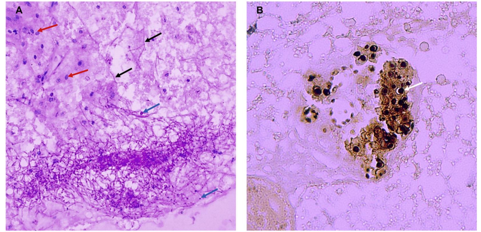 Microscopic analysis of infected tissue. larvae were