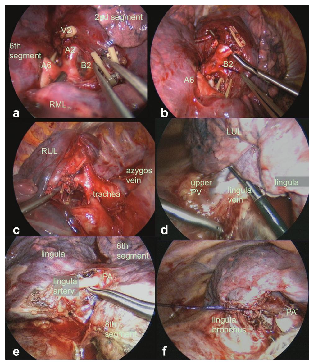 Dissection and division of the segmental hilar structures of