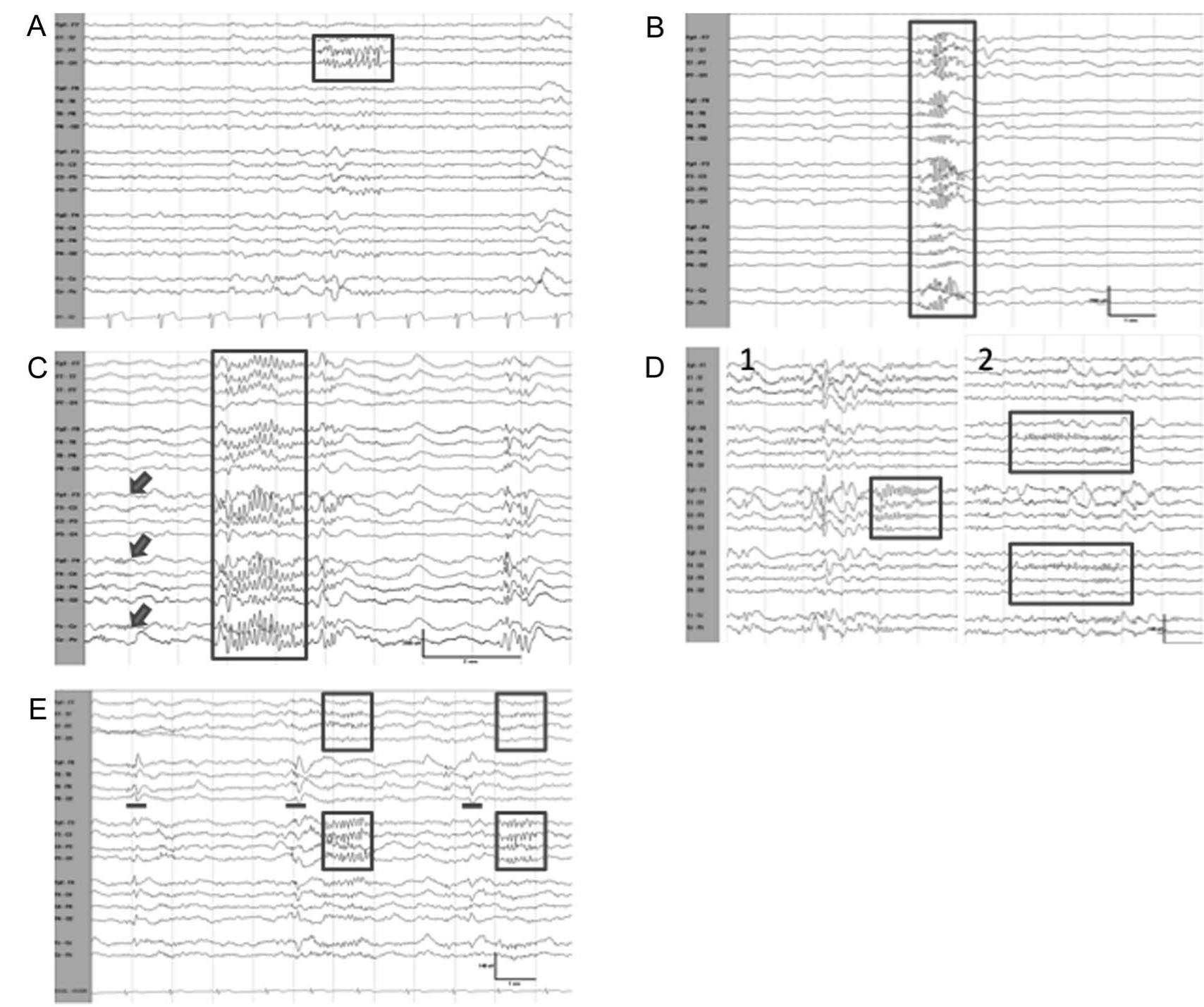 Examples of b(i)rds. a, lateralized b(i)rds; 29-year-old man