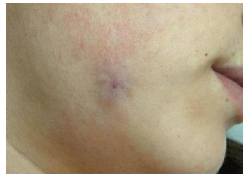 33 atypical mycobacteria: maxillary abscess produced by m.