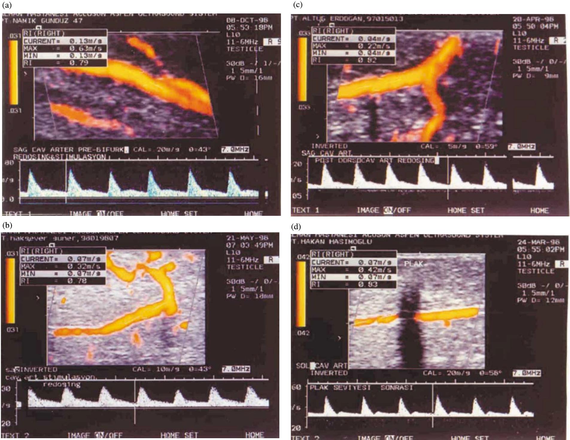 (a) intrapenile bifid cavernosal arterial system with